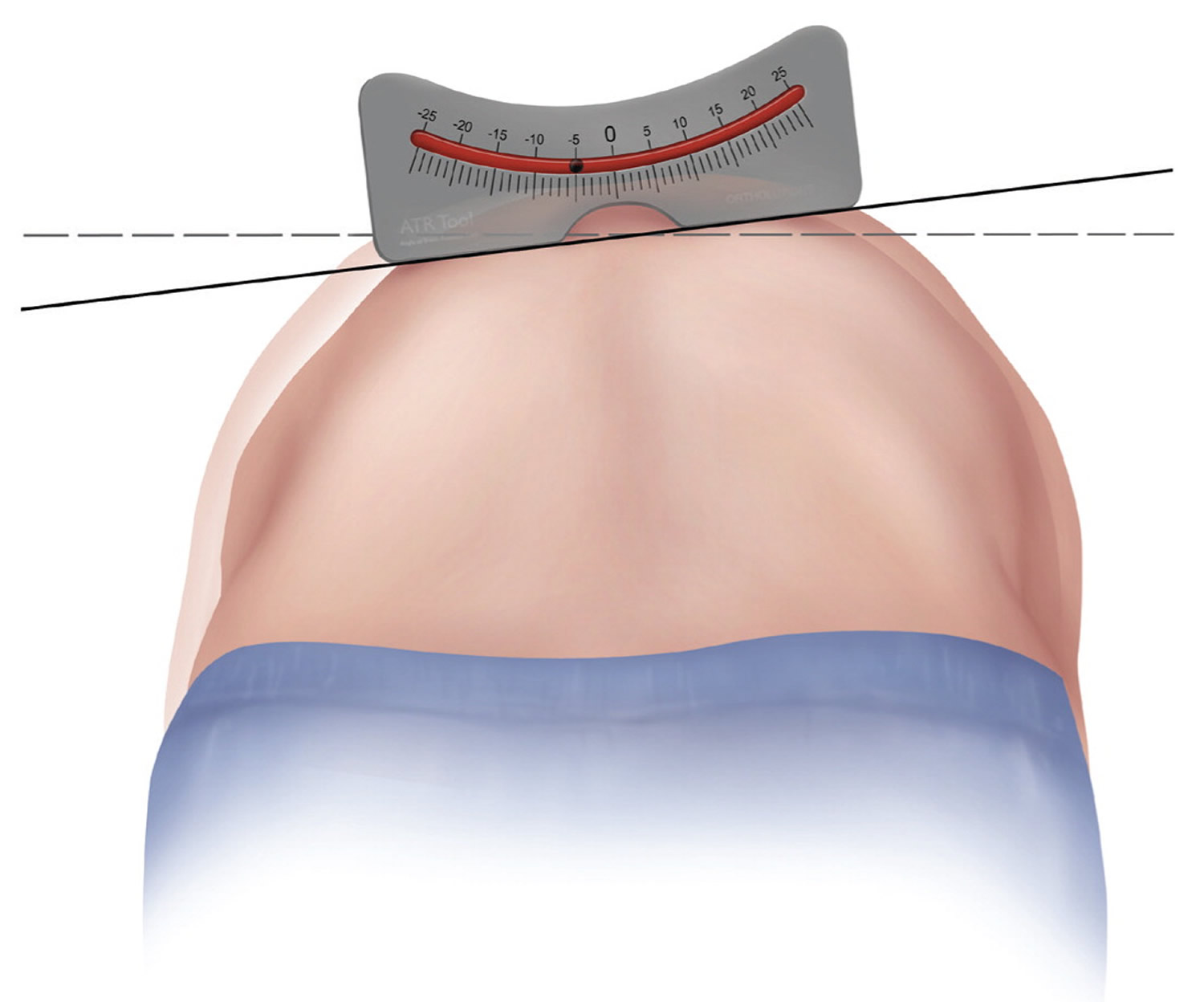Scoliosis Adults Children Causes Treatment Brace Exercise
