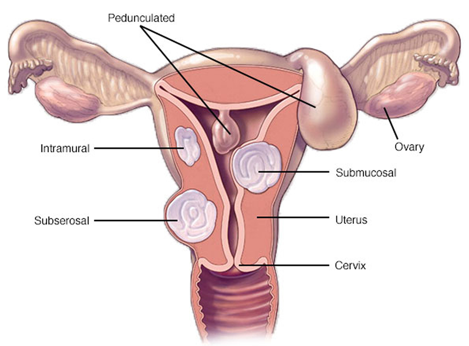 Uterine Fibroids Causes Symptoms Diagnosis Treatment Pregnancy Uterine Fibroids Causes Symptoms Diagnosis Treatment Pregnancy