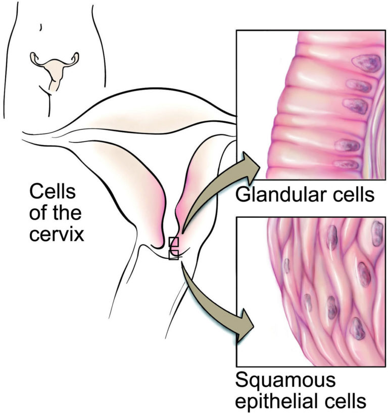 Cervical Ectropion Causes Symptoms And Cervical Ectropion Treatment