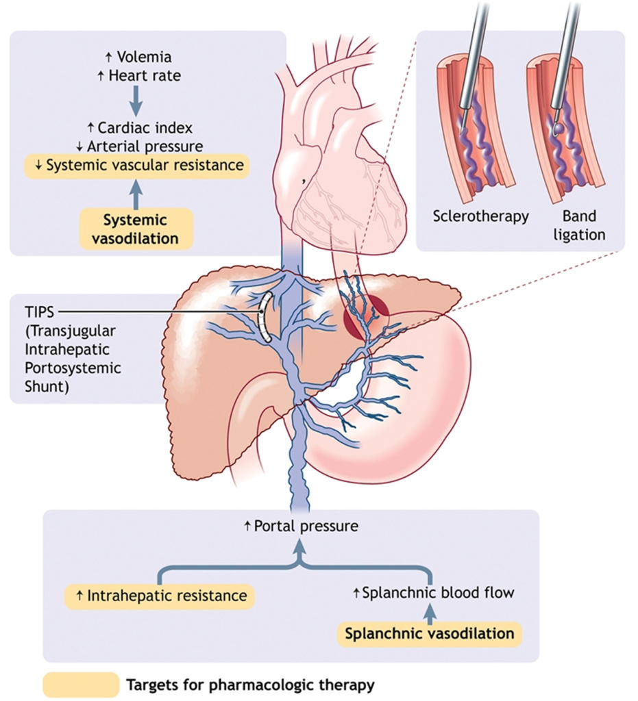 Esophageal Varices Causes Symptoms Grading Diagnosis Treatment
