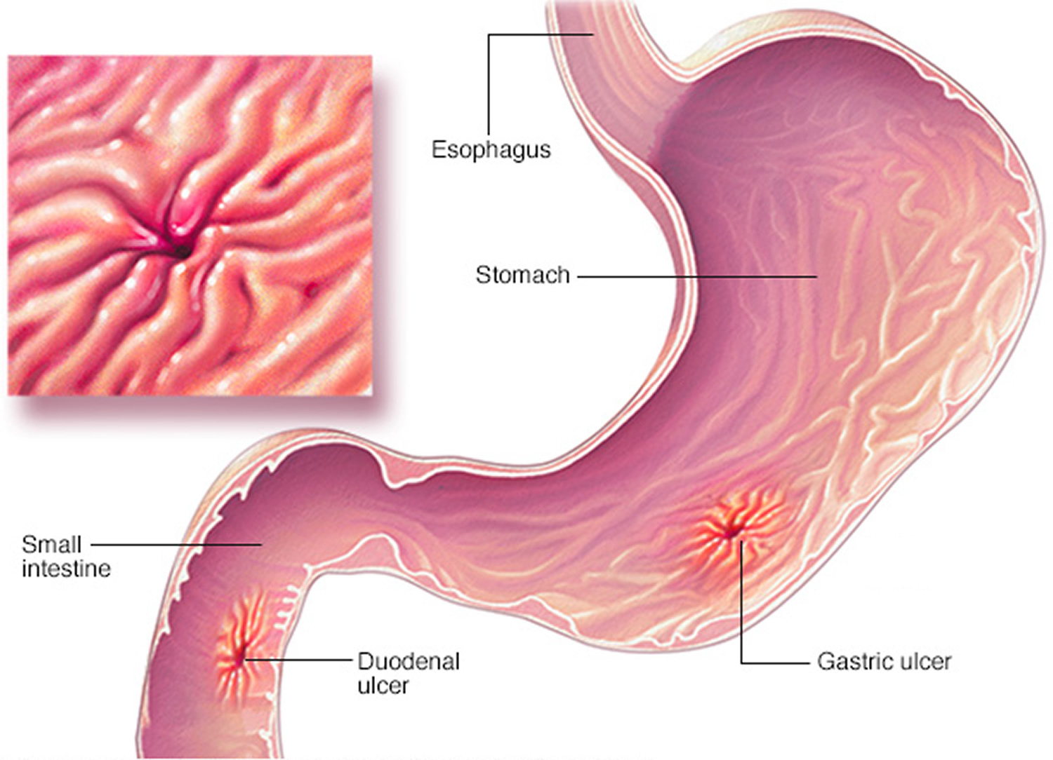 Helicobacter Pylori Infection Bacteria Symptoms Test Treatment