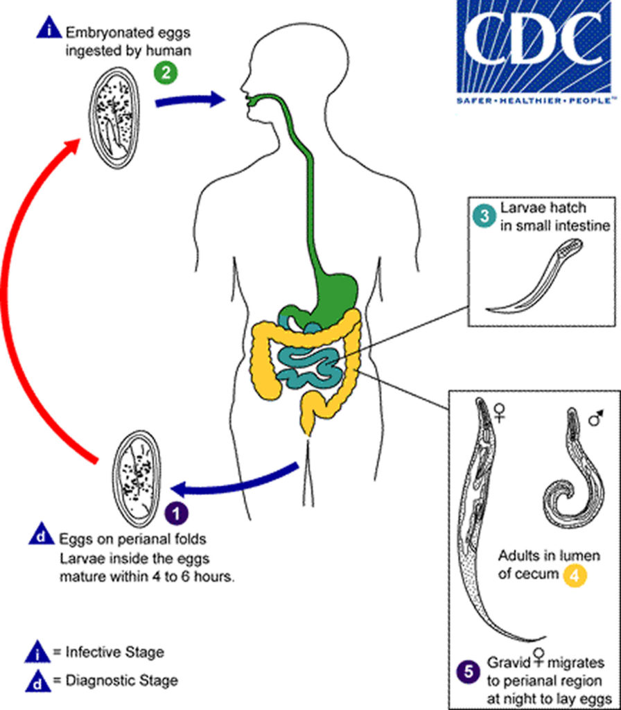Pinworm Infection - Symptoms, Anus, Diagnosis, Treatment