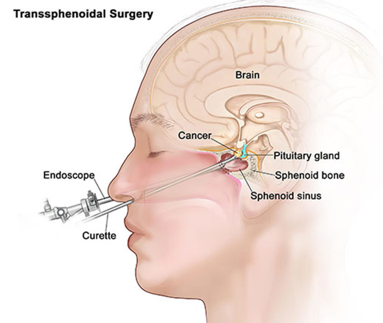 Pituitary Tumor Signs Symptoms Diagnosis Mri Surgery And Treatment