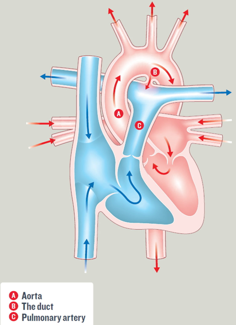 Patent Ductus Arteriosus Causes Symptoms Diagnosis Treatment