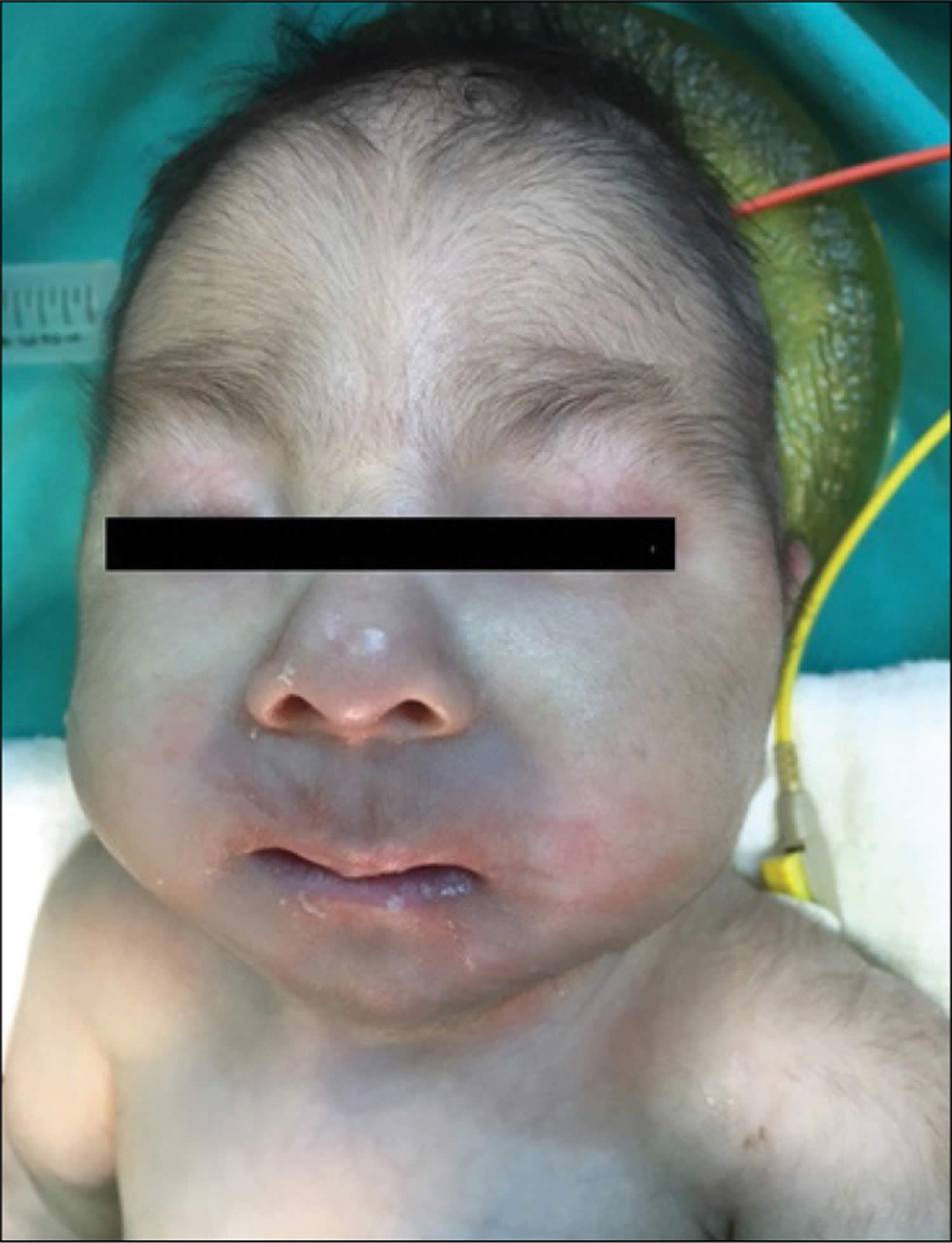 Trisomy 18 Edwards Syndrome Causes Symptoms Life Expectancy Treatment
