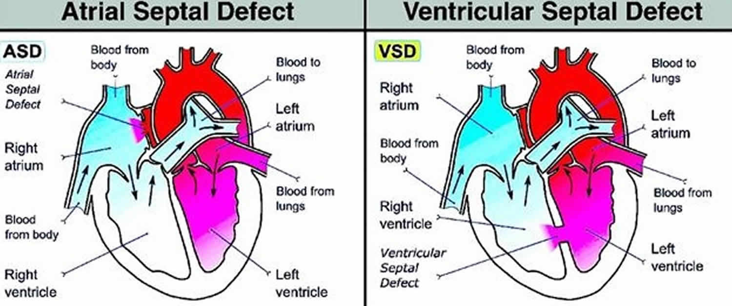 Hole In Heart Causes Symptoms Prognosis Diagnosis And Treatment