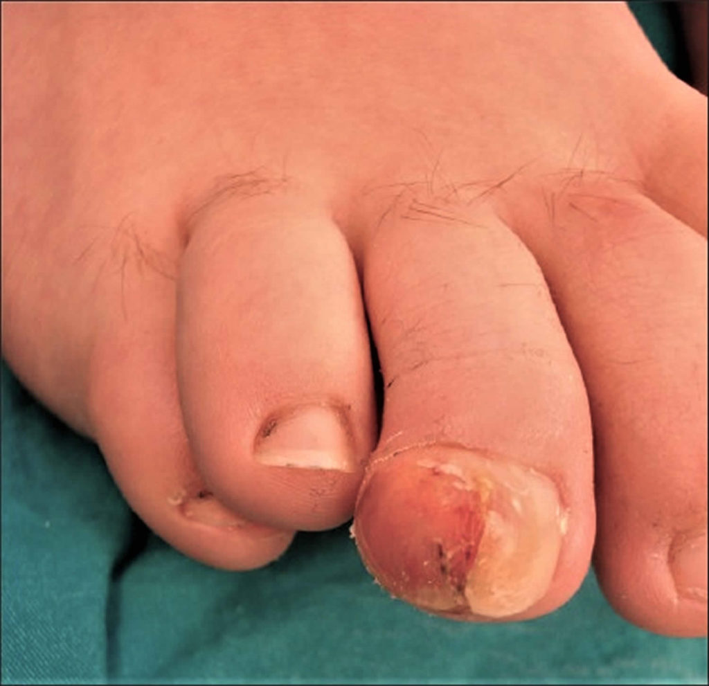 Exostosis Causes Symptoms And Exostosis Treatment