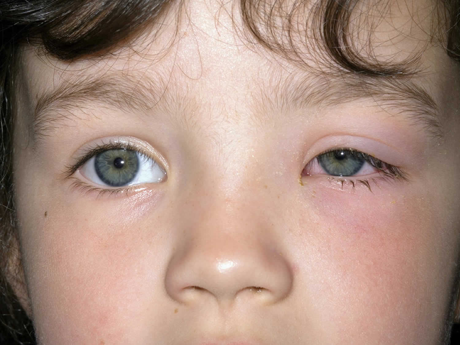 Periorbital Cellulitis Orbital Cellulitis Causes Symptoms Diagnosis