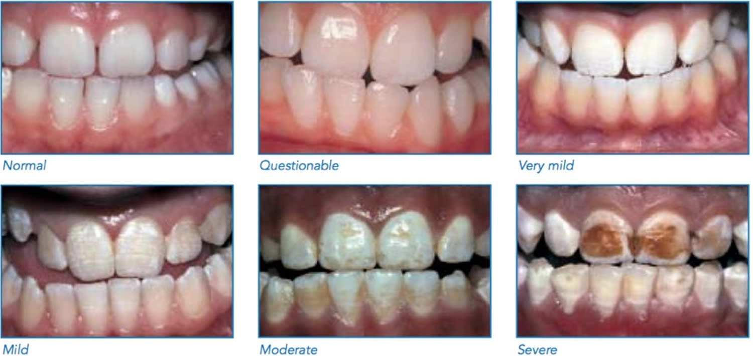 Dental Fluorosis Causes Prevention Symptoms Dental Fluorosis Treatment Dental Fluorosis Causes Prevention Symptoms Dental Fluorosis Treatment
