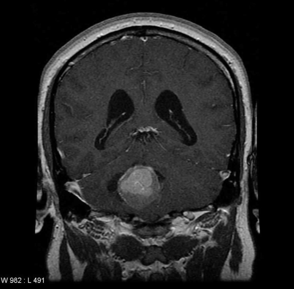 Choroid Eye And Choroid Plexus Function And Choroid Plexus Tumors