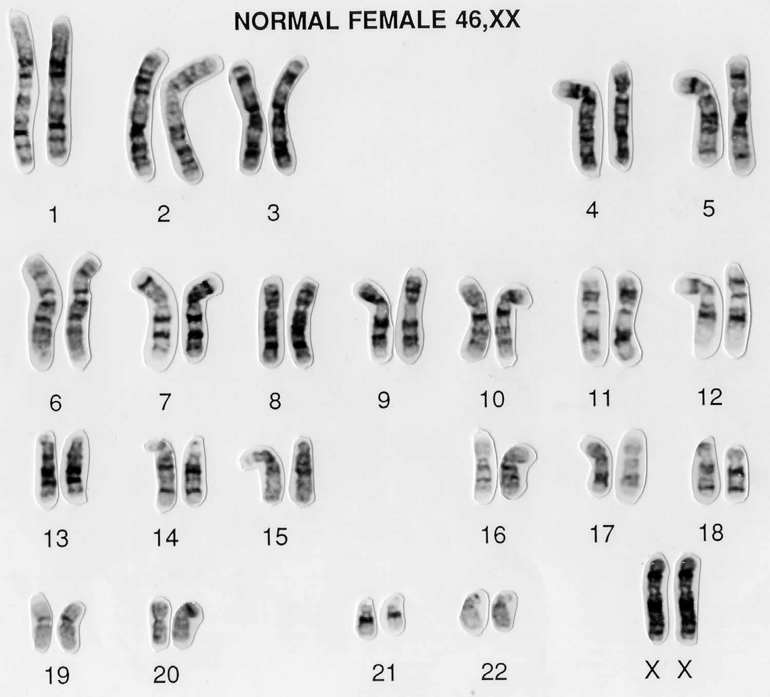 Karyotype Karyotype Test Analysis Normal Karyotype Abnormal Karyotype
