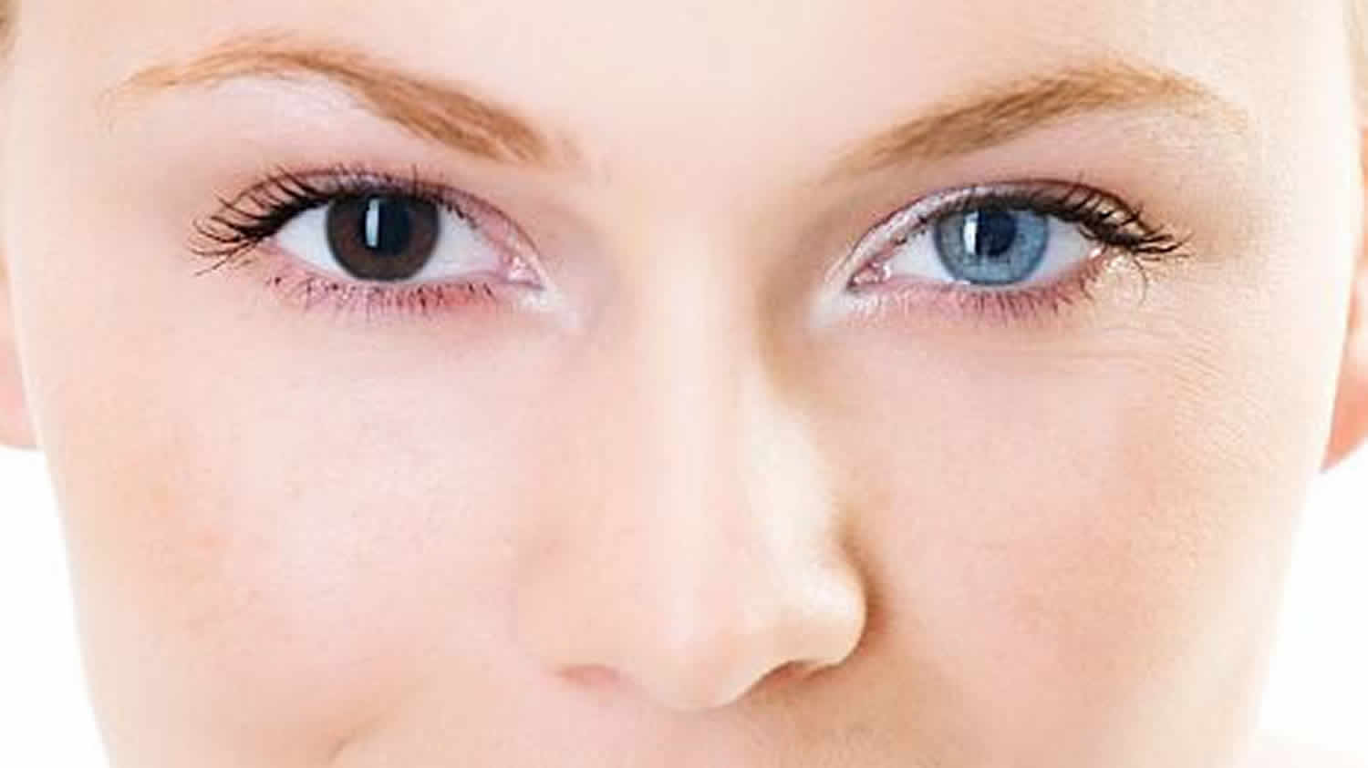 Heterochromia Eyes In Humans Causes How Rare Is Heterochromia Iridis 