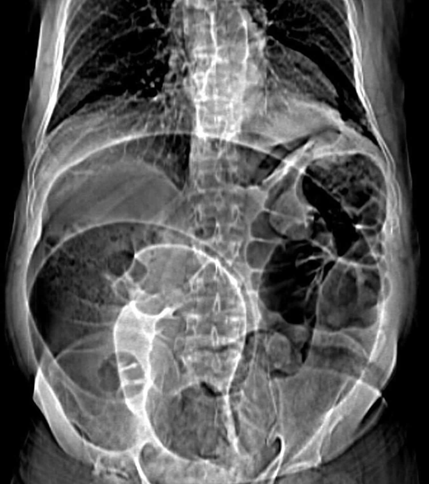 Volvulus Definition Causes Volvulus Types Diagnosis Volvulus Treatment