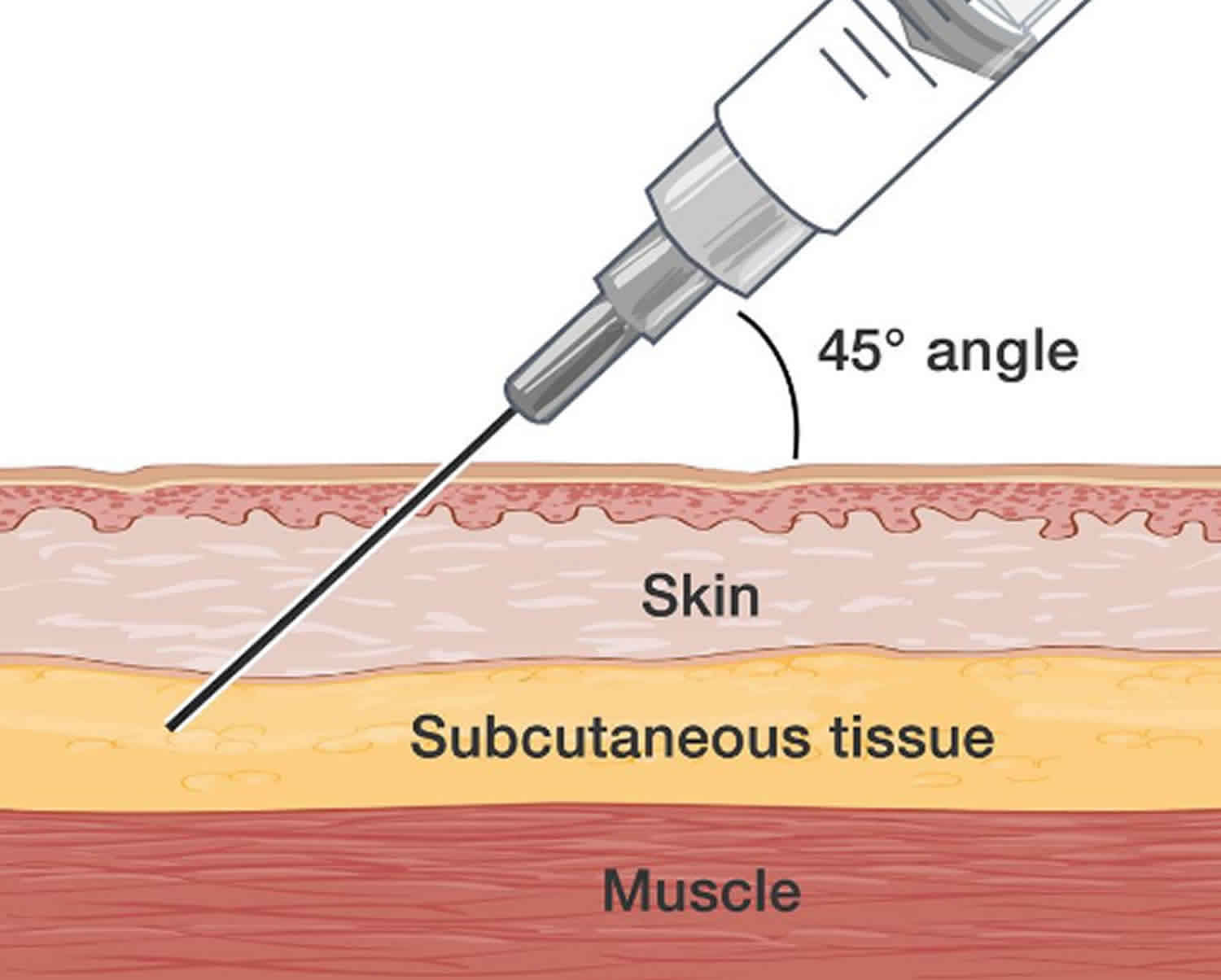 Subcutaneous Injection Sites How To Give Subcutaneous Injection Technique