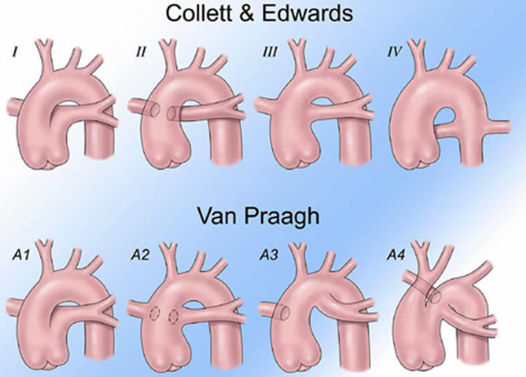 Truncus Arteriosus Causes Symptoms Diagnosis Treatment And Prognosis