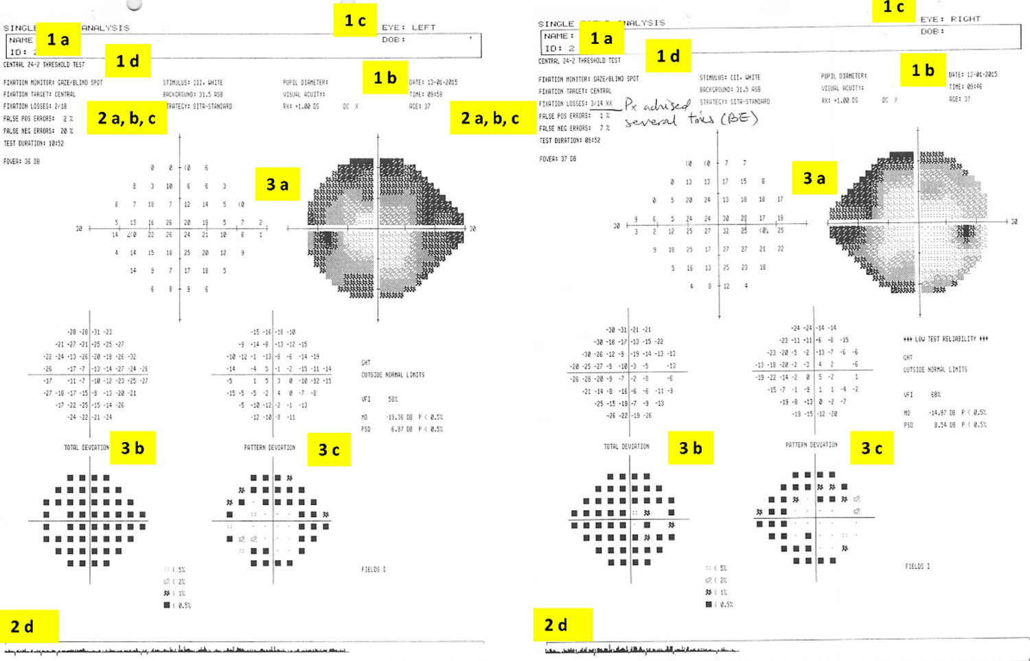 Visual Field Test Visual Field Test Results Interpretation