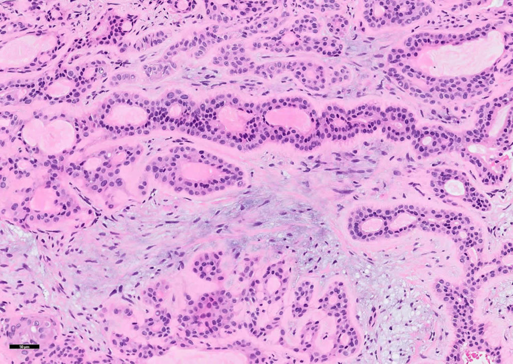Pleomorphic Adenoma Causes Symptoms Diagnosis Treatment And Prognosis