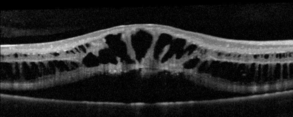 Retinoschisis Causes Symptoms Diagnosis And Retinoschisis Treatment