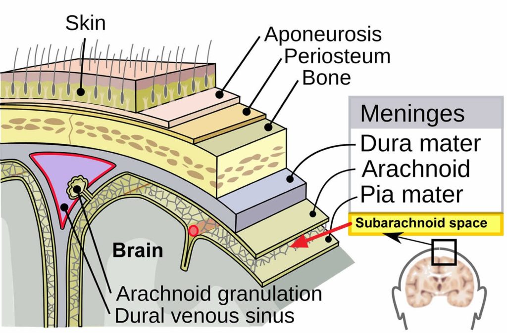 Subarachnoid Hemorrhage Causes Symptoms Diagnosis Treatment And Prognosis