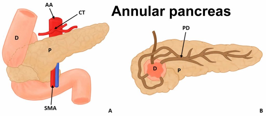 Annular Pancreas Causes Symptoms Diagnosis Treatment And Prognosis
