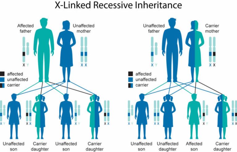 Lowe syndrome causes, symptoms, diagnosis, treatment & prognosis